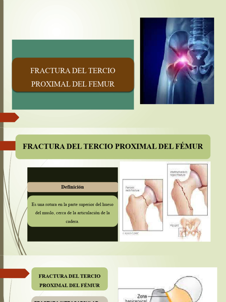 Fractura del Tercio Proximal del Fémur | PDF | Medicina CLINICA ...