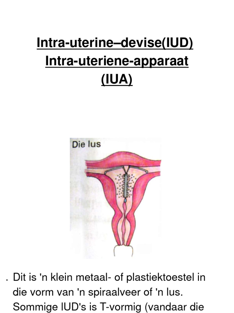 LES 25 Intra-Uterine-Devise (IUD) Intra-Uteriene-Apparaat ( | PDF