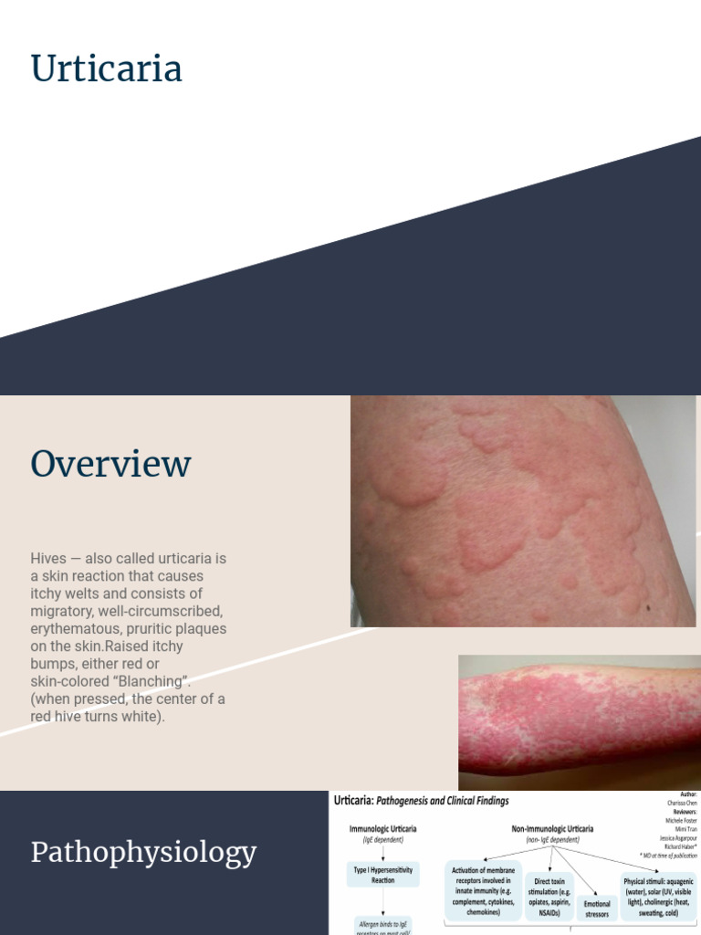 Urticaria | PDF
