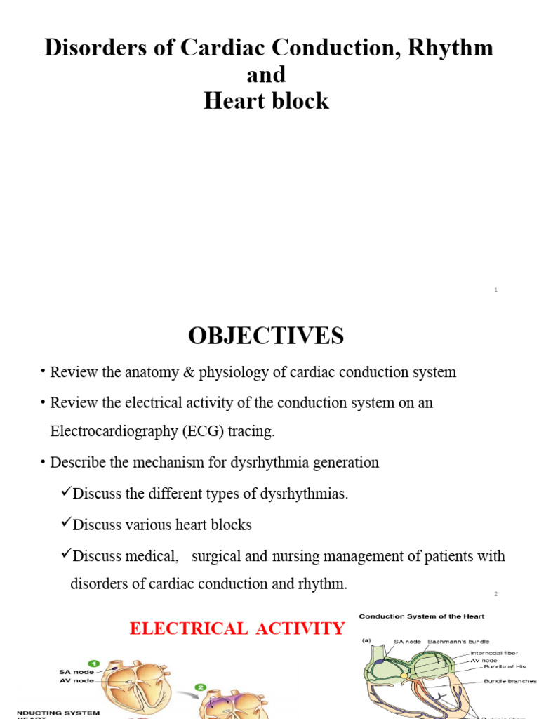 Cardiac Arrhythmia & Basics ECG | Download Free PDF ...