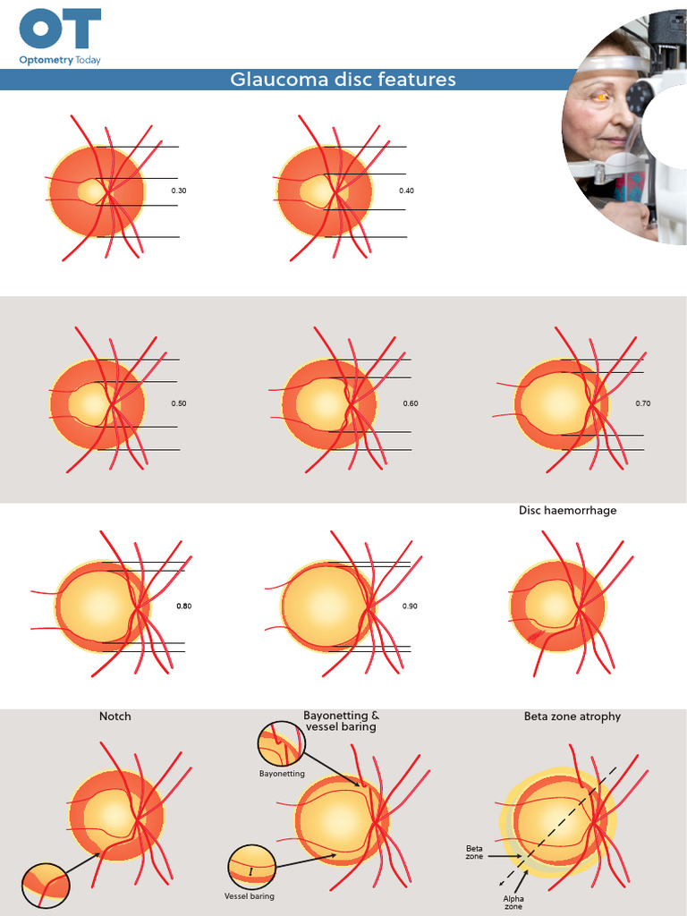 Glaucoma Disc Features Analysis | PDF | Facial Features | Clinical Medicine