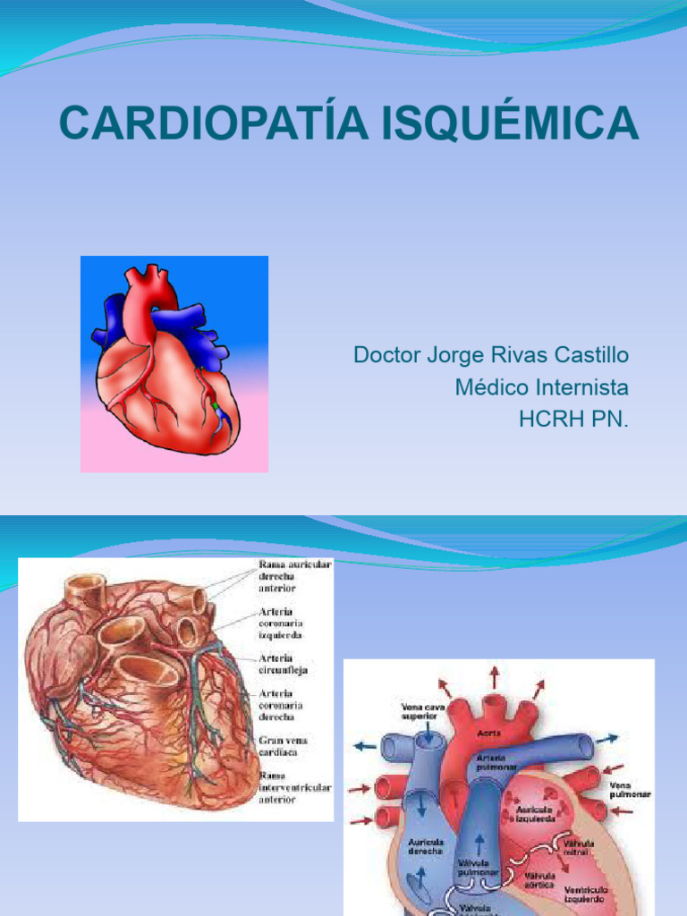 Cardiopatía Isquémica | PDF | Infarto de miocardio | Isquemia