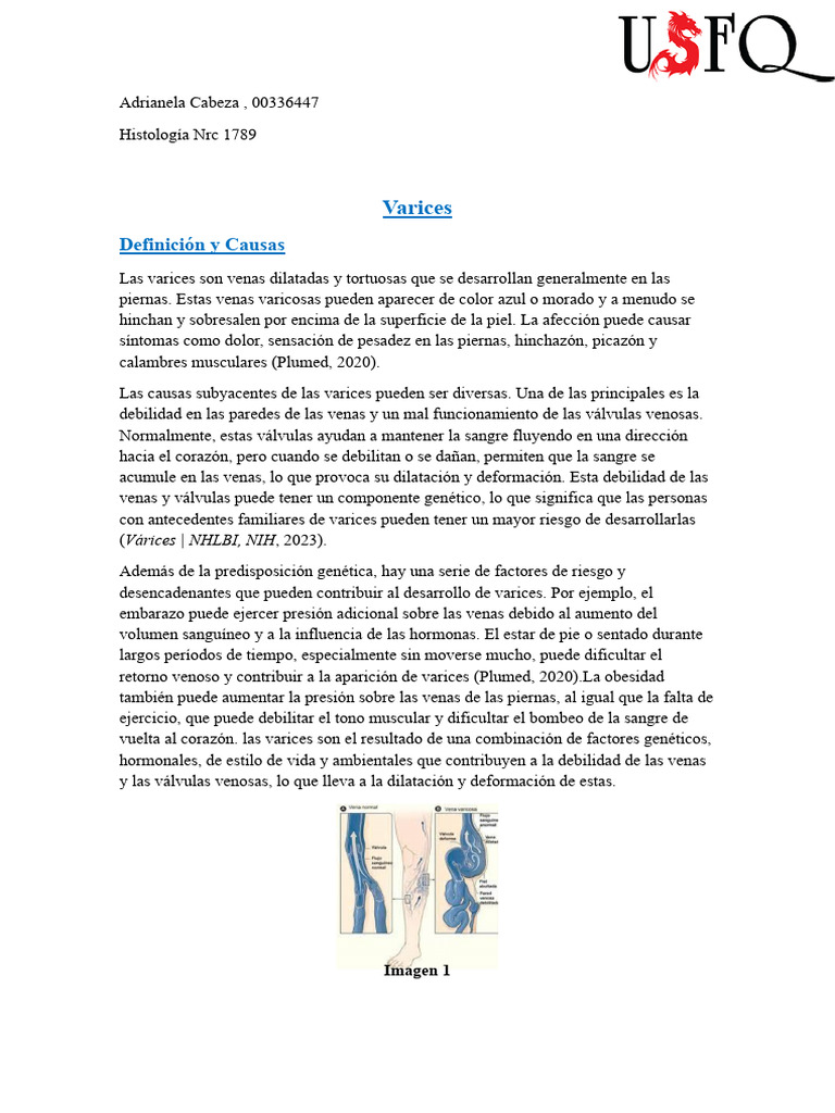 Varices: Causas y Tratamientos Efectivos | PDF | Venas varicosas | Vena