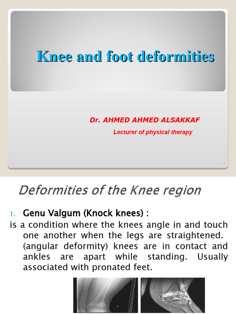 Knee and Foot Deformities Overview | PDF | Knee | Foot