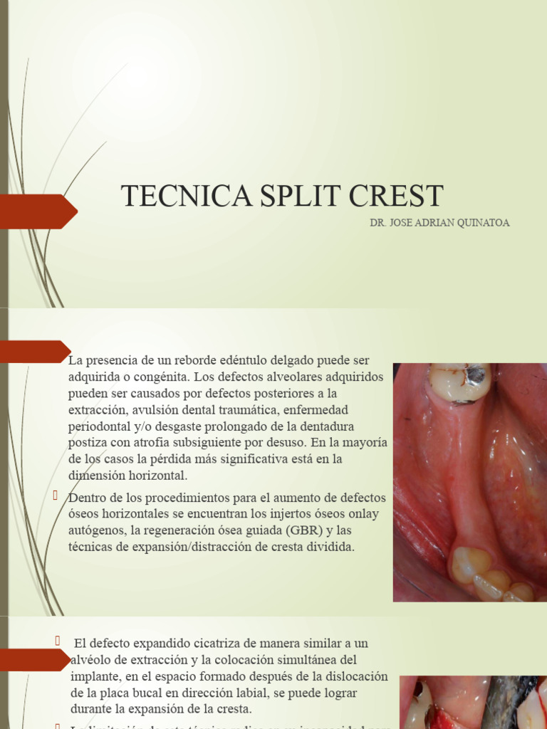 Tecnica Split Crest | Descargar gratis PDF | Hueso | Piezoelectricidad