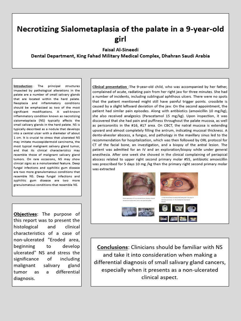 Necrotizing Sialometaplasia of The Palate in A 9-Year-Old Girl | PDF ...
