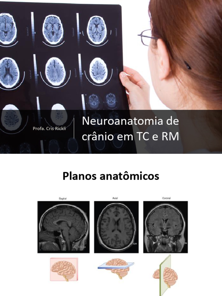 Neuroanatomia de Crânio em TC e RM: Profa. Cris Rickli | PDF | Cerebelo ...