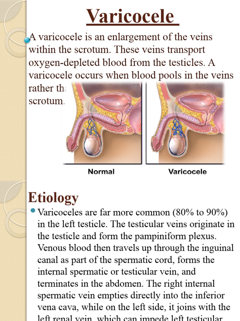 Understanding Varicocele Symptoms and Treatment | PDF | Self ...