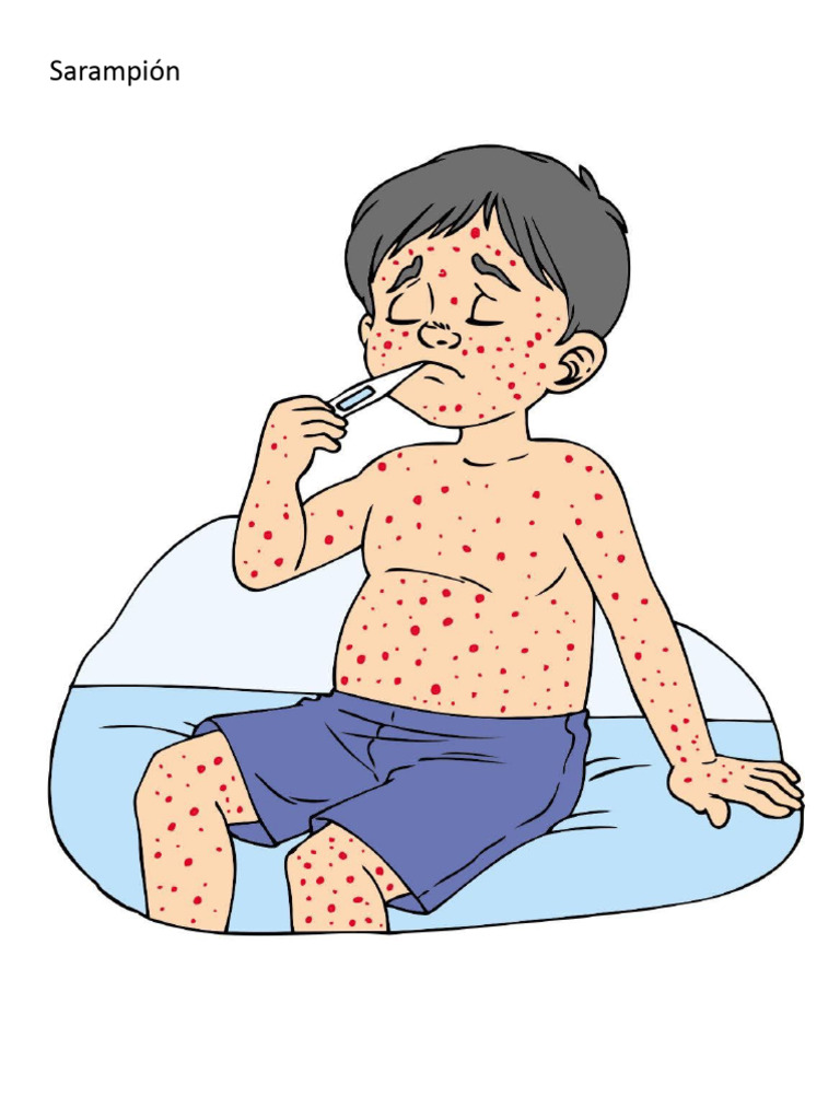Sarampión | PDF