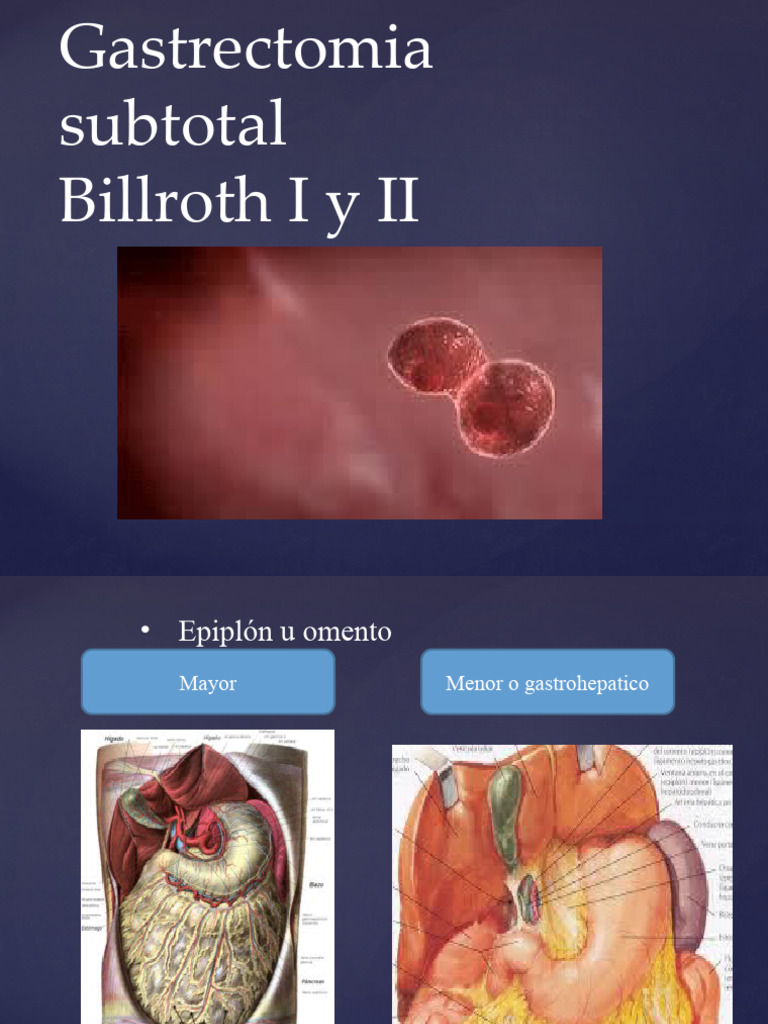 Billroth 1 y 2 | PDF | Estómago | Abdomen