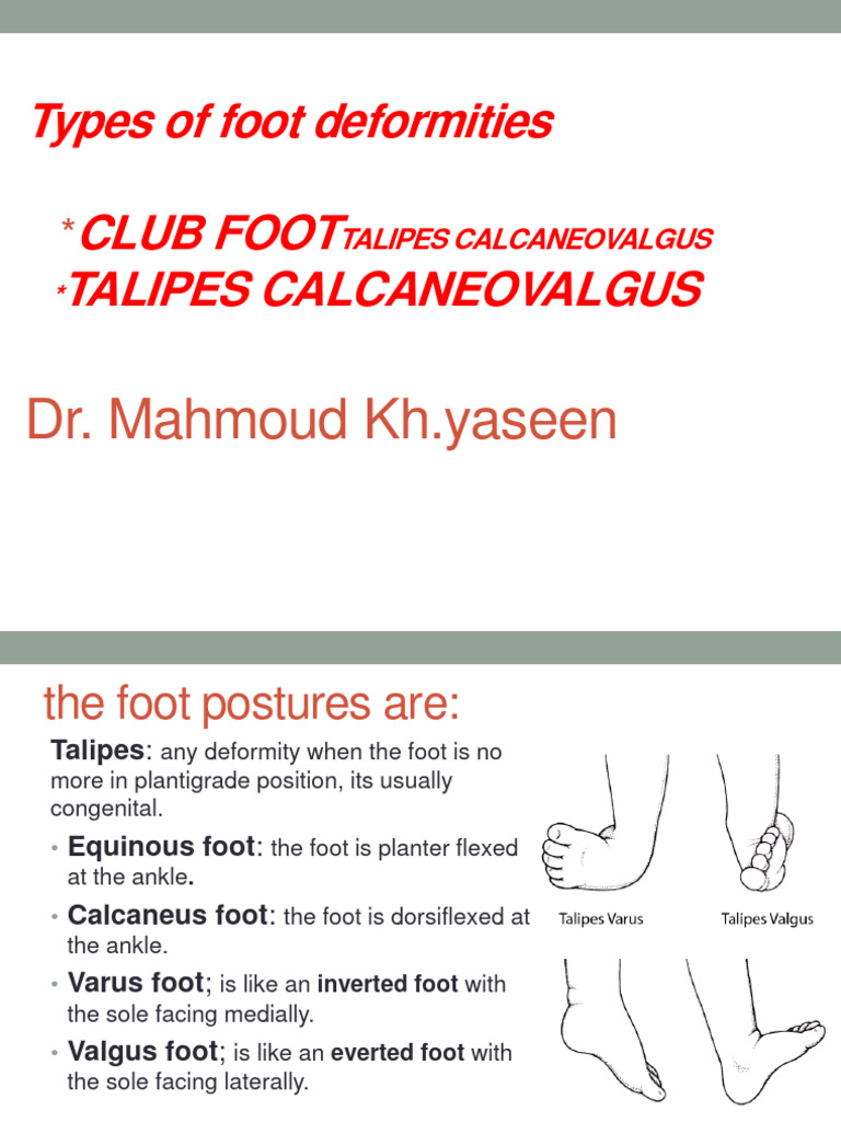 Clubfoot | Download Free PDF | Foot | Ankle