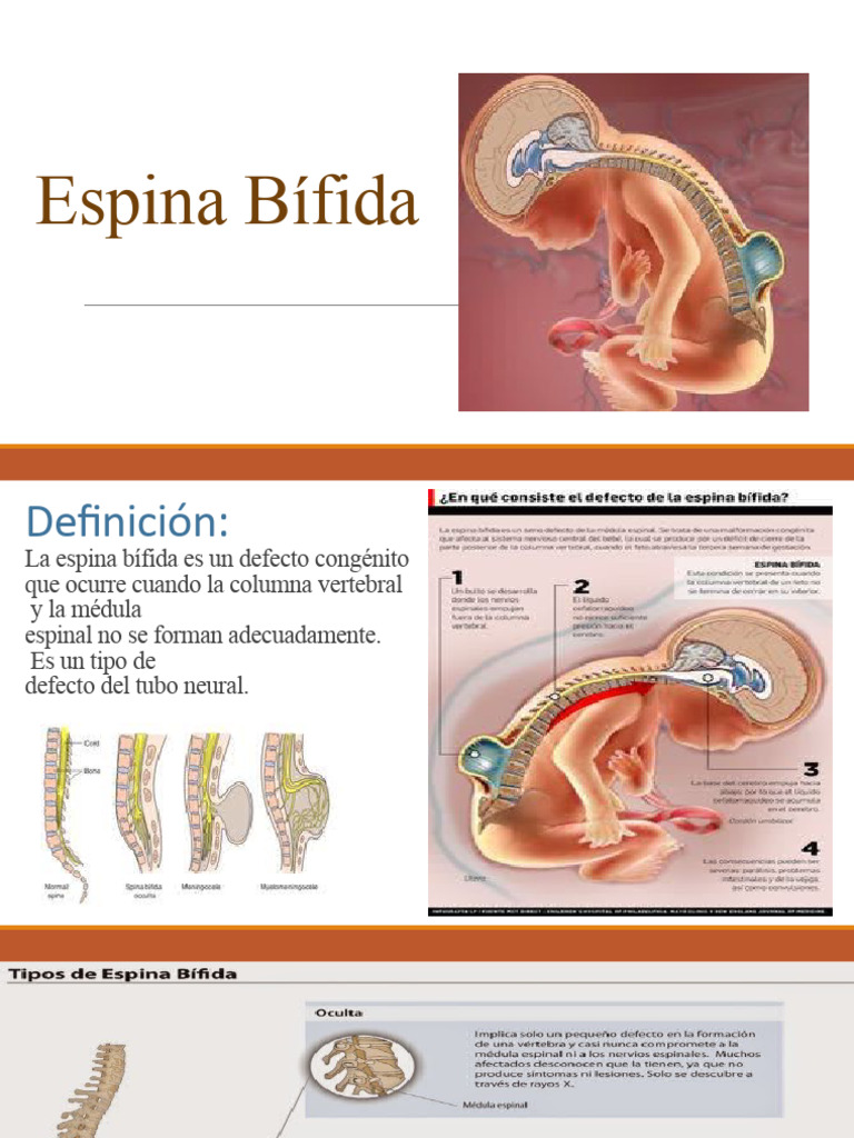 Espina Bifida | PDF