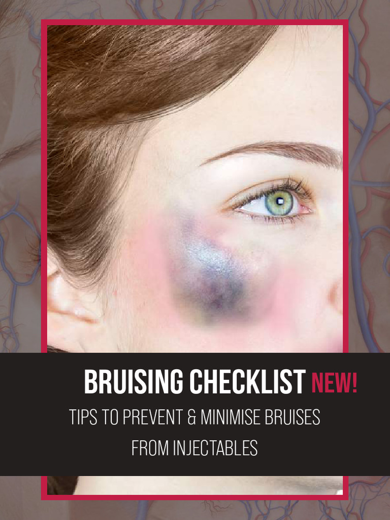 Bruising Checklist Sogkw | PDF | Vasodilation | Blood Vessel