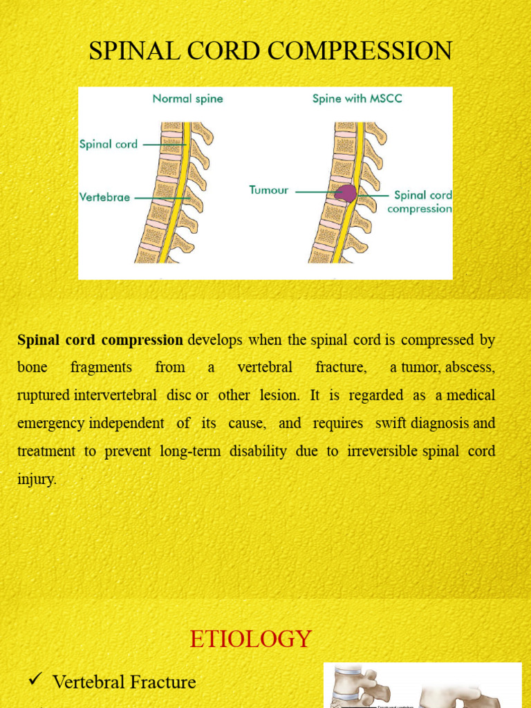 Spinal Cord Compression | PDF | Back Pain | Clinical Medicine
