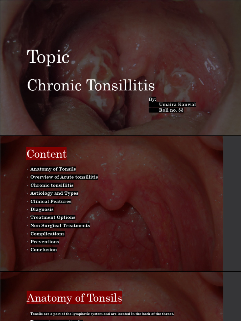 Chronic Tonsillitis | PDF | Epidemiology | Causes Of Death