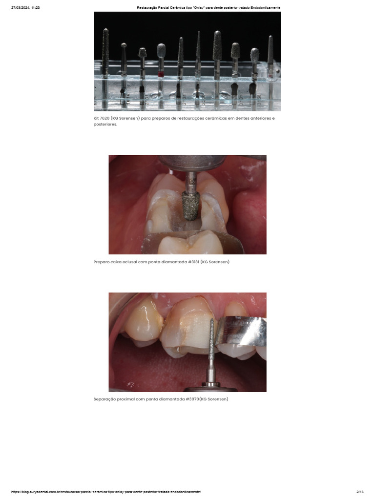Restauração Parcial Cerâmica Tipo - Onlay - para Dente Posterior ...