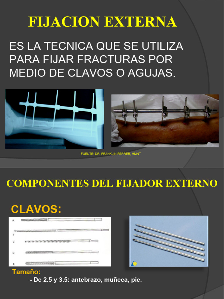 fijacion externa | PDF | Rodilla | Rigidez