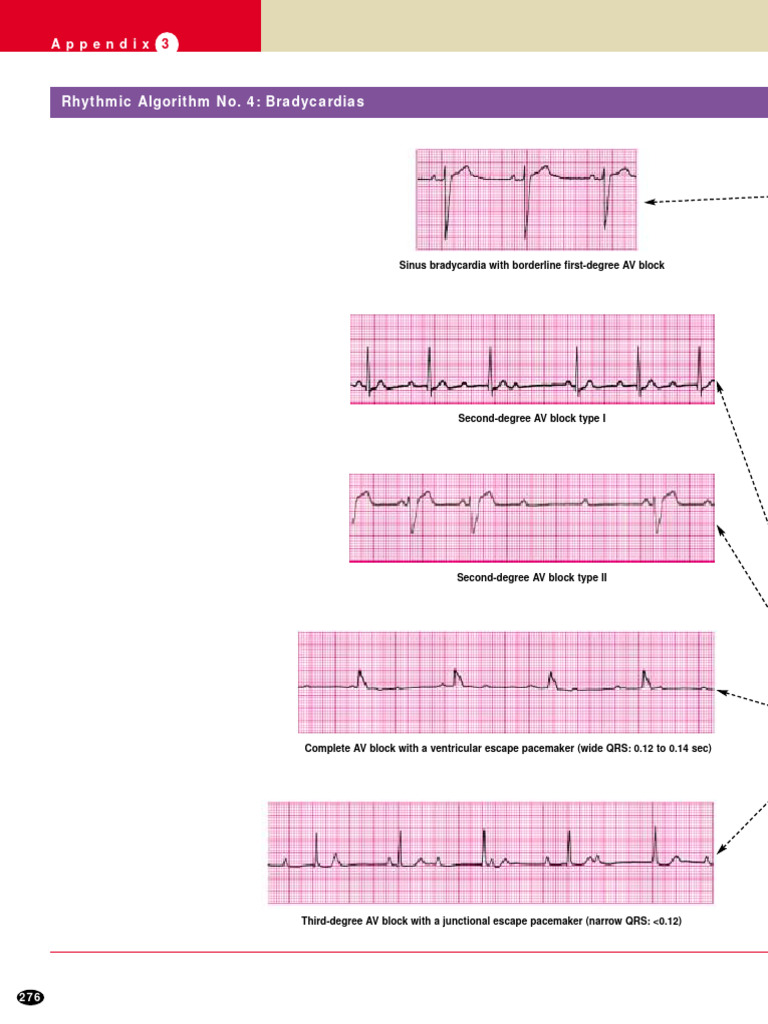ECG_Rhythms_for_ACLS_201309101532569240 pages 276, 277 | PDF | Cardiovascular Diseases ...