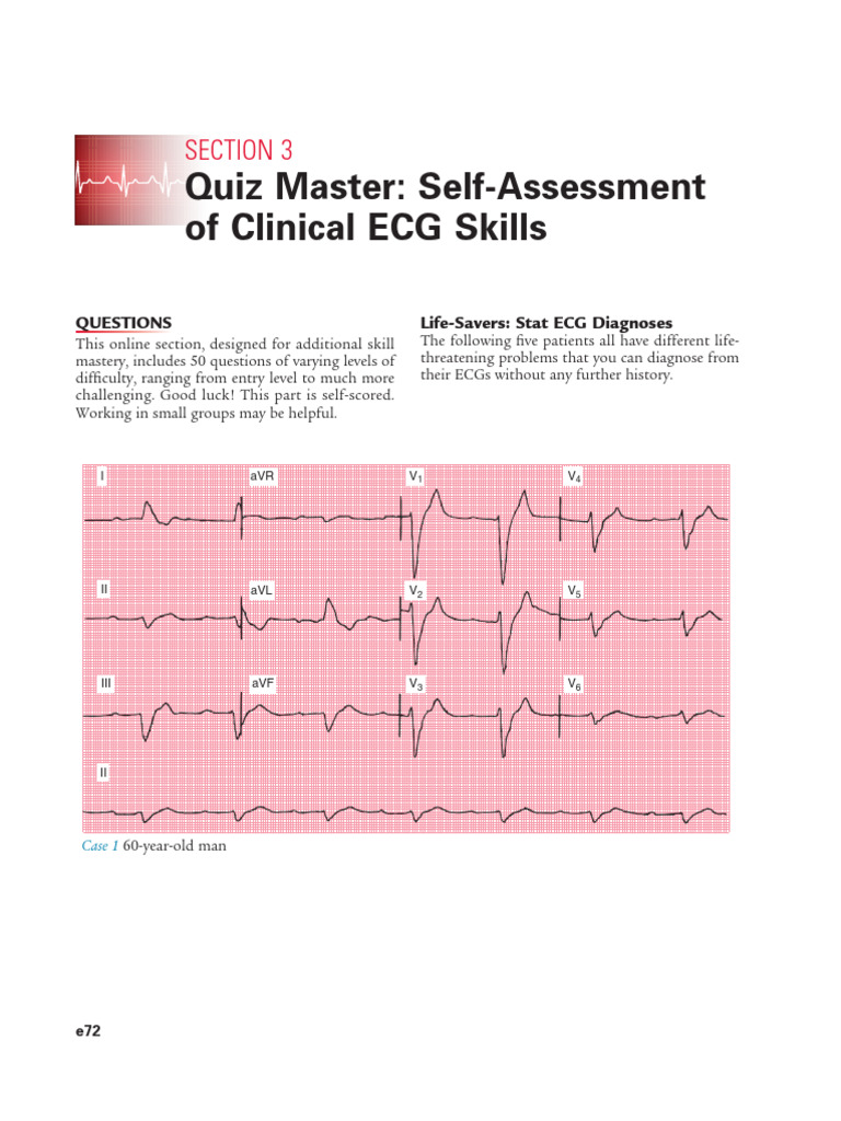 This Ekg | PDF | Electrocardiography | Myocardial Infarction