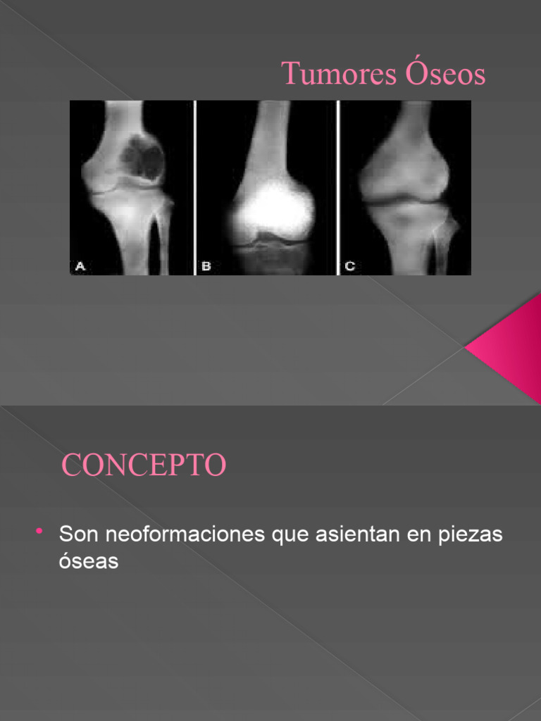Tumores Oseos | PDF | Hueso | Cáncer