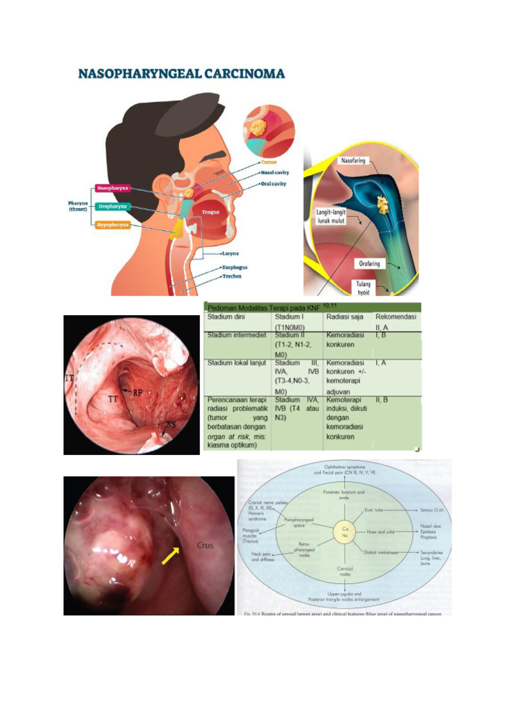 Print PBL Ca Nasofaring | PDF