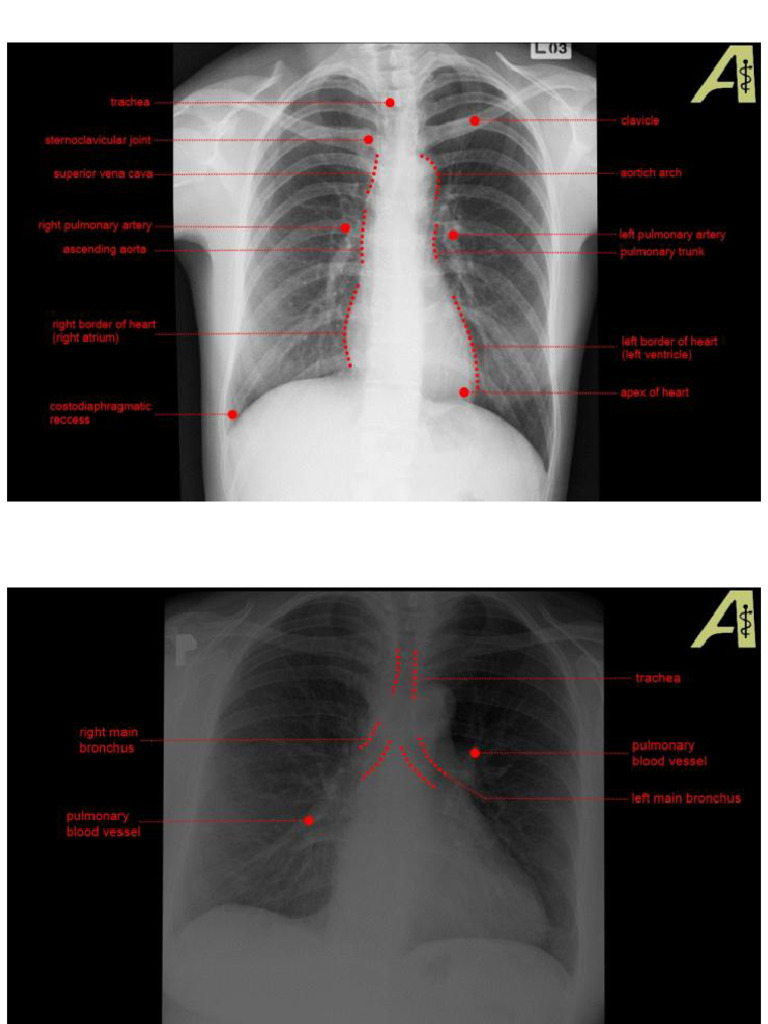 Thorax CT | PDF