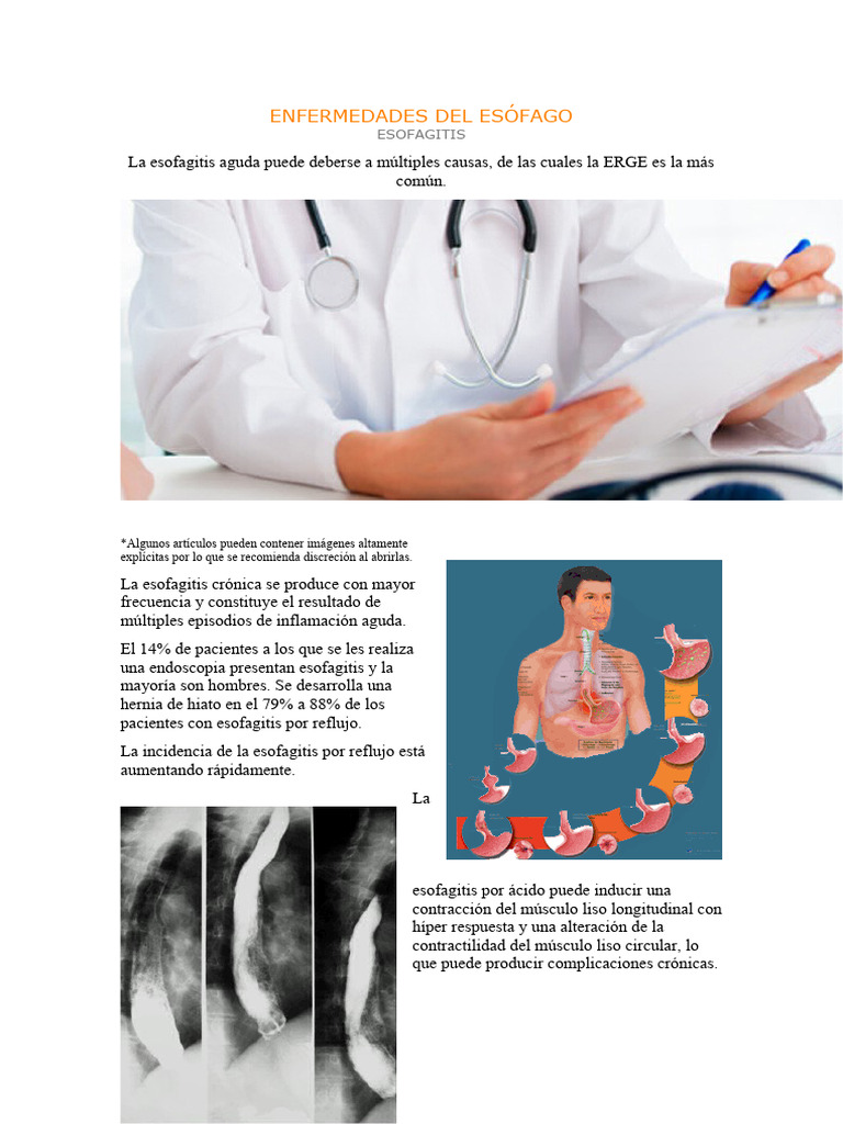 ENFERMEDADES DEL ESÓFAGO | PDF | La enfermedad por reflujo ...