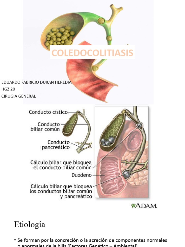 COLEDOCOLITIASIS | PDF | Sistema digestivo | Especialidades Medicas