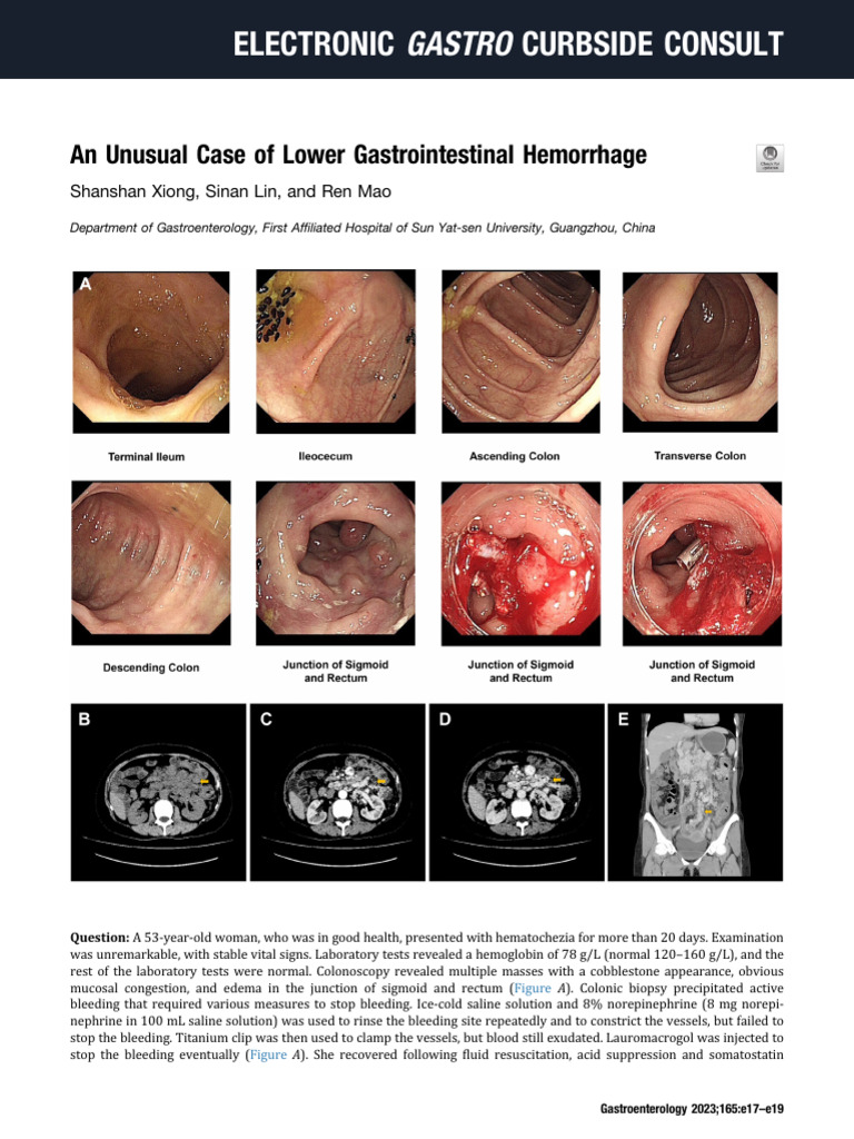 Uncommon Cause of Lower GI Bleeding | PDF | Large Intestine | Angiography