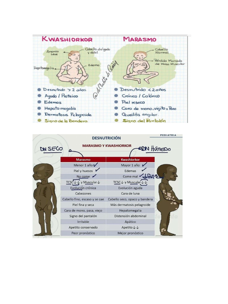 Kwashiorkir + Marasmo | PDF