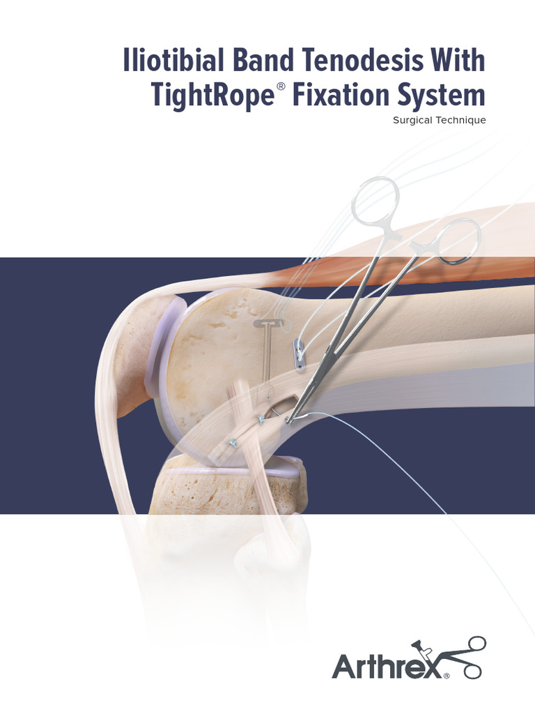 Iliotibial Band Tenodesis With Tightrope Fixation System | PDF | Knee ...