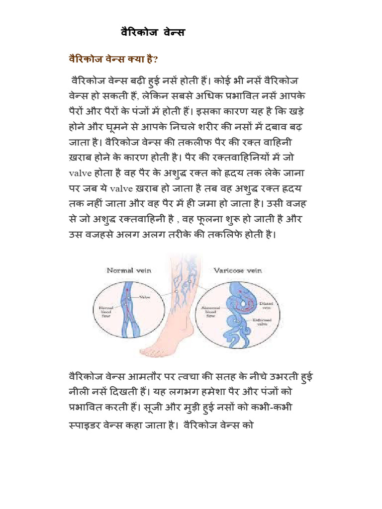 Varicose Vein Booklet | PDF