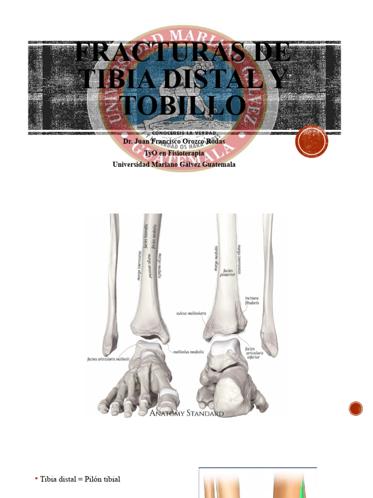 Tratamiento de Fracturas de Tibia y Tobillo | PDF | Tobillo | Medicina ...