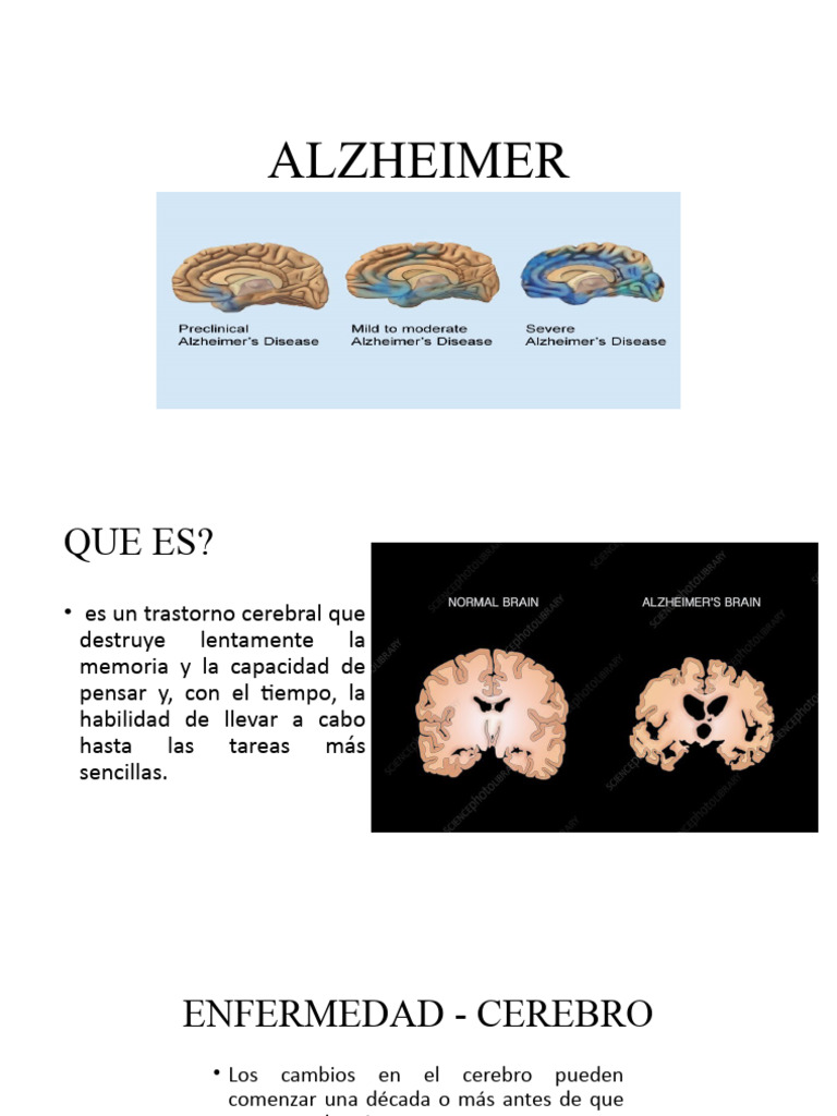 Guía Completa sobre la Enfermedad de Alzheimer | PDF | Enfermedad de ...
