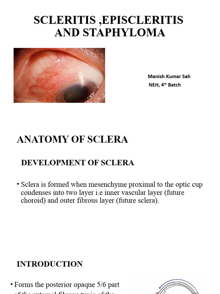 Scleral Disorders: Scleritis & Episcleritis | PDF | Causes Of Death ...