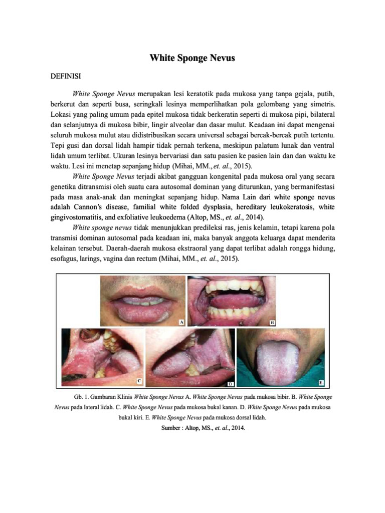Definisi White Sponge Nevus | PDF | Kesehatan Holistik