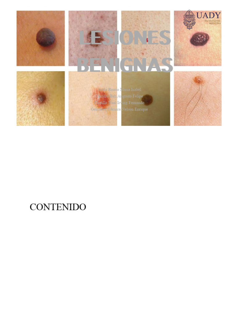 Lesiones Benignas | PDF | Melanoma | Piel