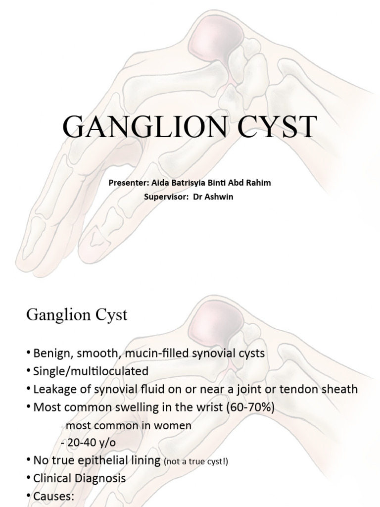 Overview of Ganglion Cysts | PDF | Hand | Musculoskeletal System
