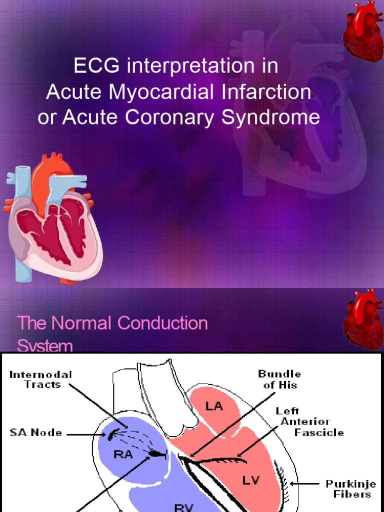 ECG in MI or ACS | PDF | Electrocardiography | Myocardial Infarction