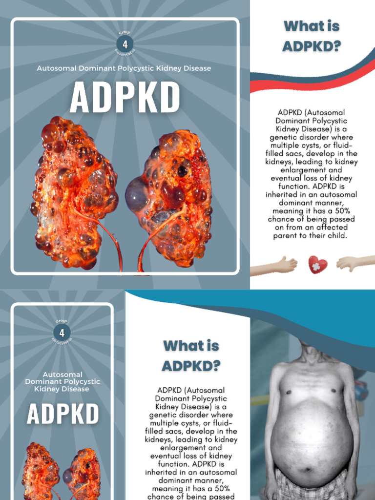 Adpkd | PDF