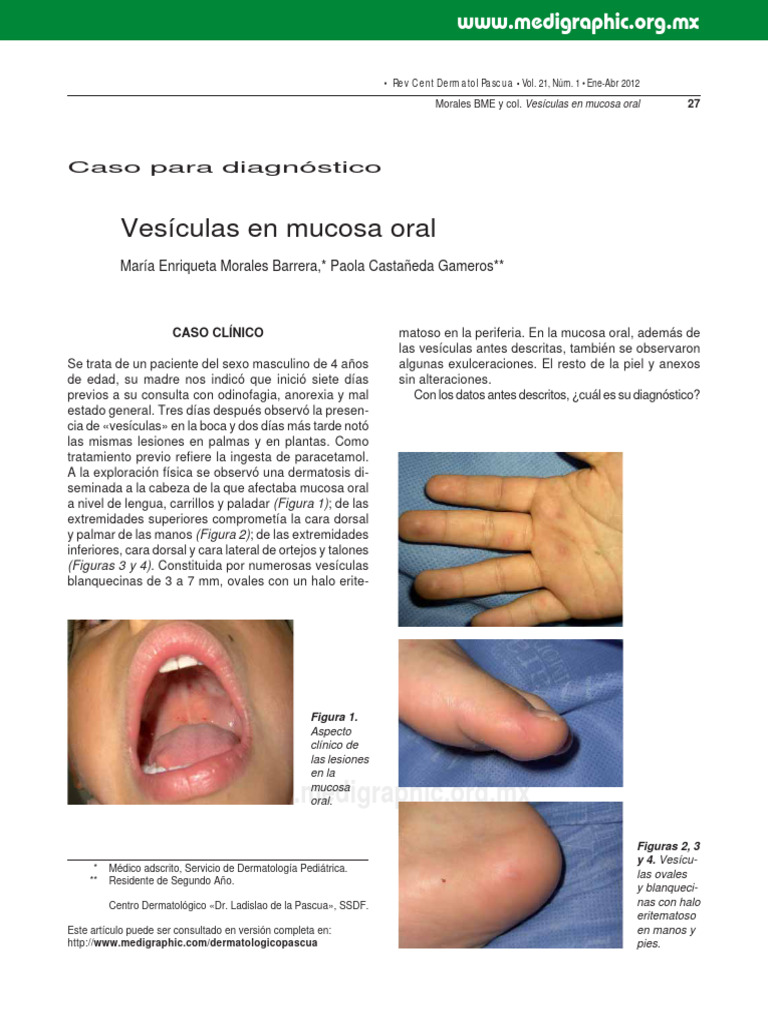 Vesículas en Mucosa Oral: Caso para Diagnóstico | Descargar gratis PDF ...