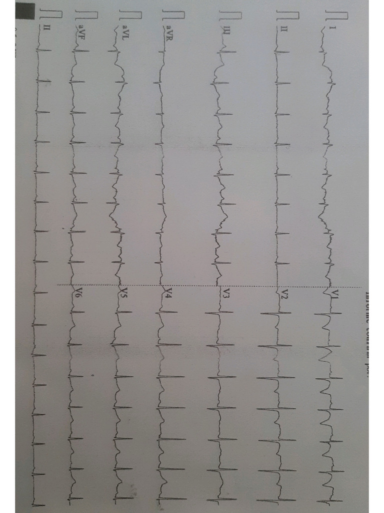 ECG | PDF