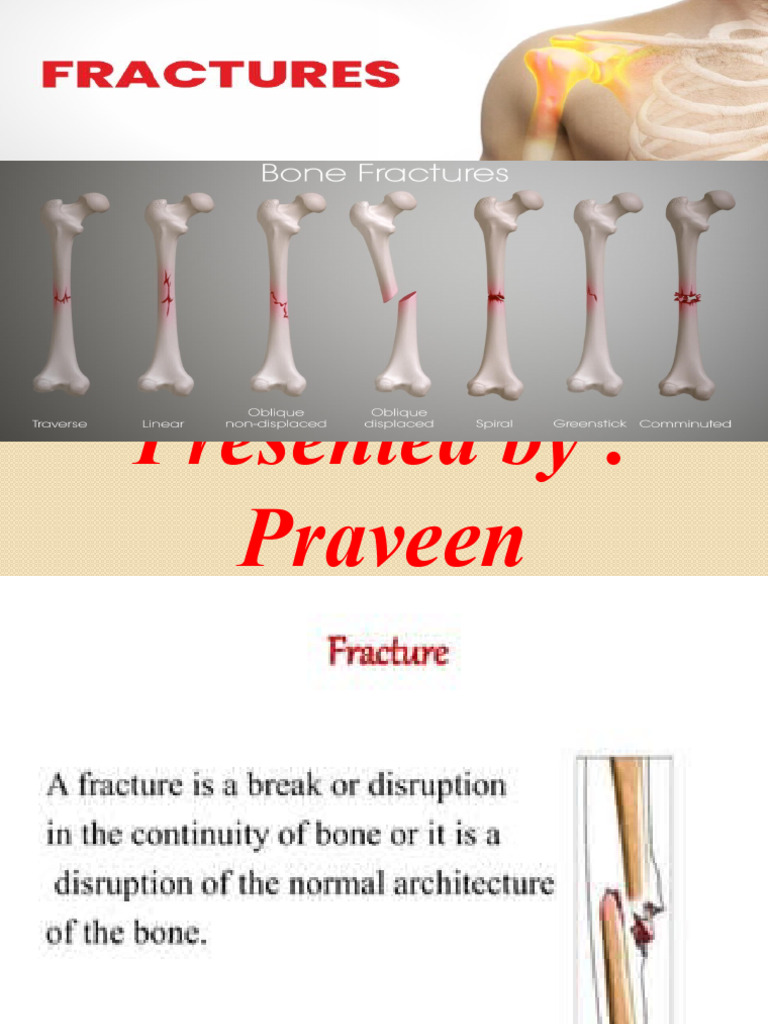 Fractures | PDF