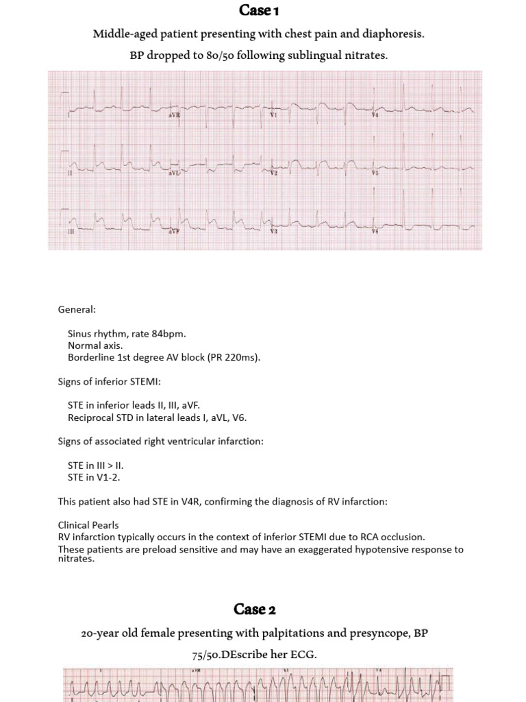 Top100 ECG Cases | PDF | Electrocardiography | Myocardial Infarction