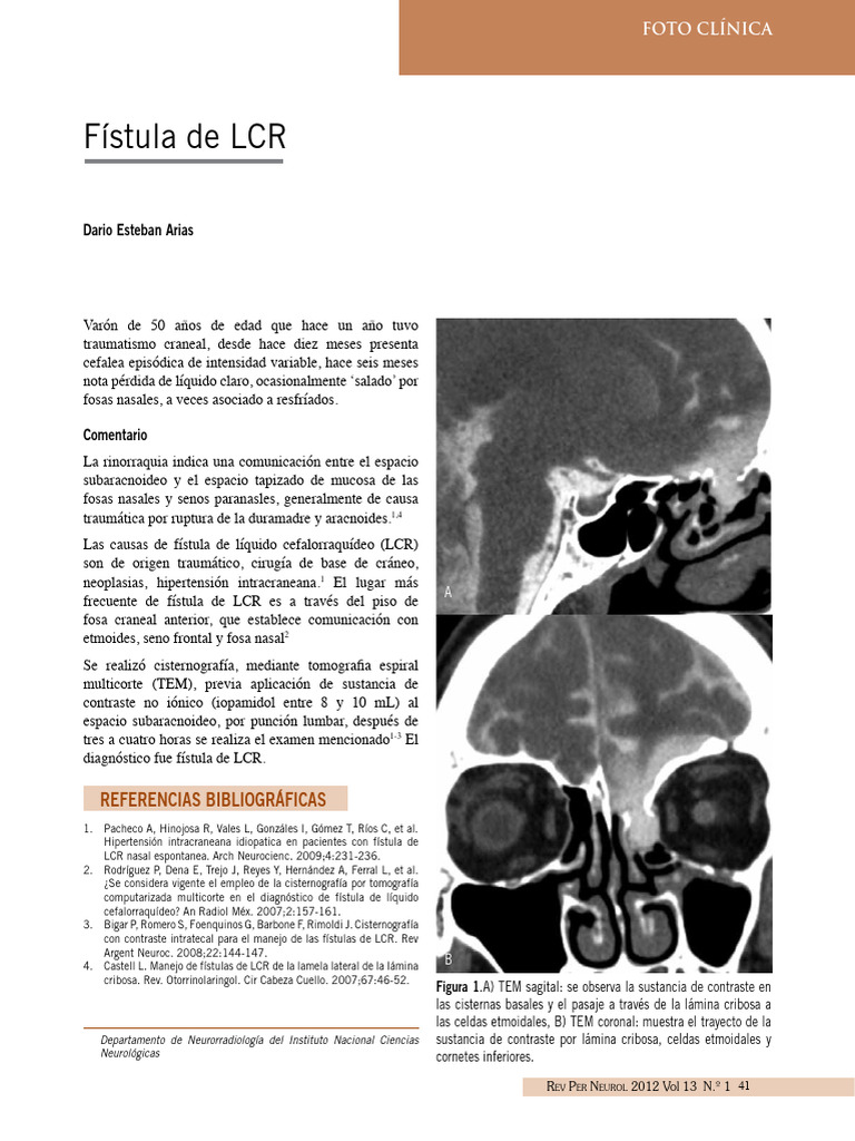 Diagnóstico de Fístula de LCR | PDF | Fluido cerebroespinal | Cabeza y cuello humanos