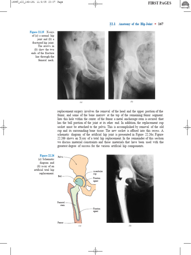 X-Rays of (A) A Normal Hip Joint and (B) A Fractured Hip Joint. The Arrows in (B) Show The Two ...
