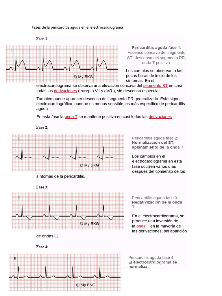 Pericarditis Aguda: Fases y Diagnóstico | PDF | Electrocardiografia ...
