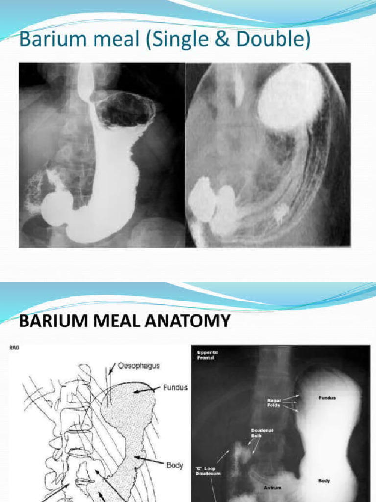 benign vs malignant gastric ulcer barium study | PDF