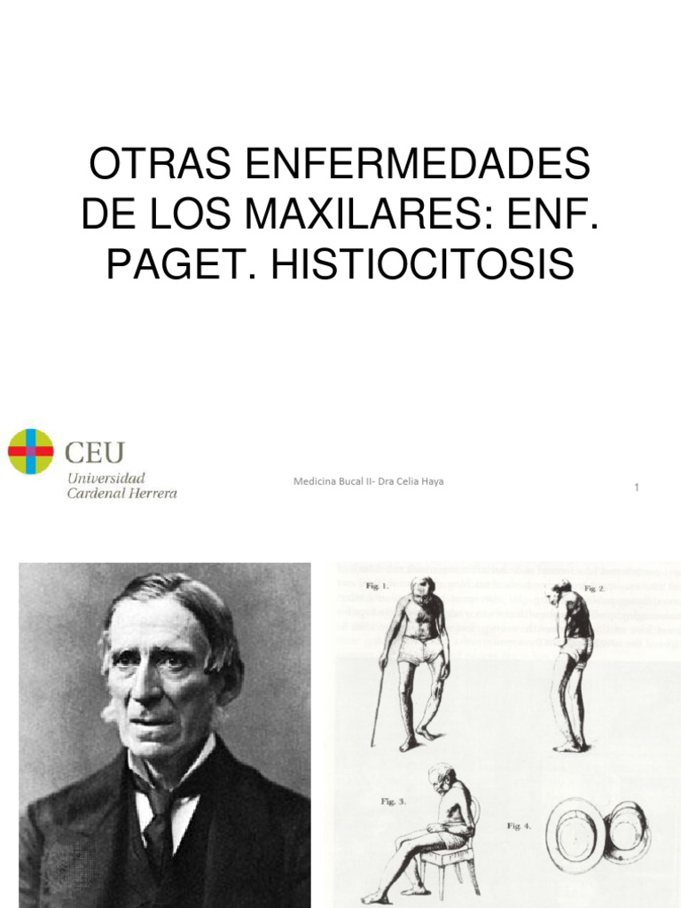 Enfermedades Maxilares: Paget y Histiocitosis | PDF | Hueso ...