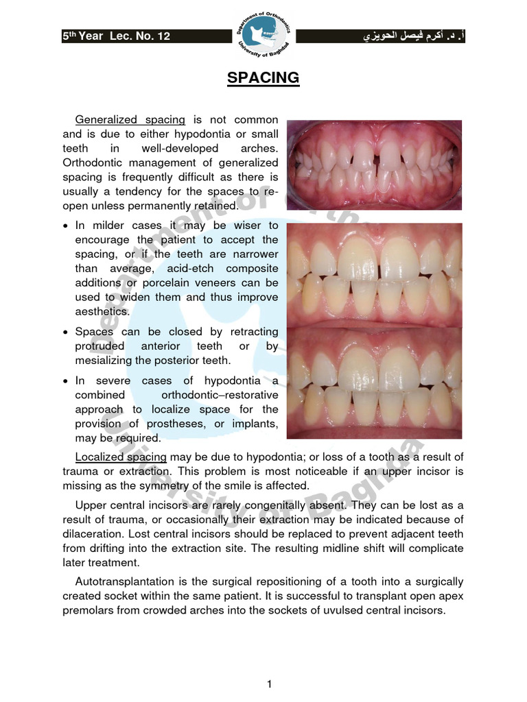 L12 Spacing - Akramalhuwaizi Akramalhuwaizi-1 | PDF | Dental Implant ...